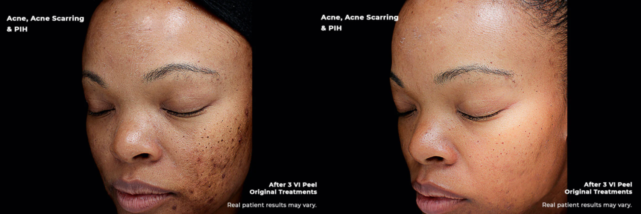 4 Essential Med Spa Treatments for People of Color - PureLee Redefined